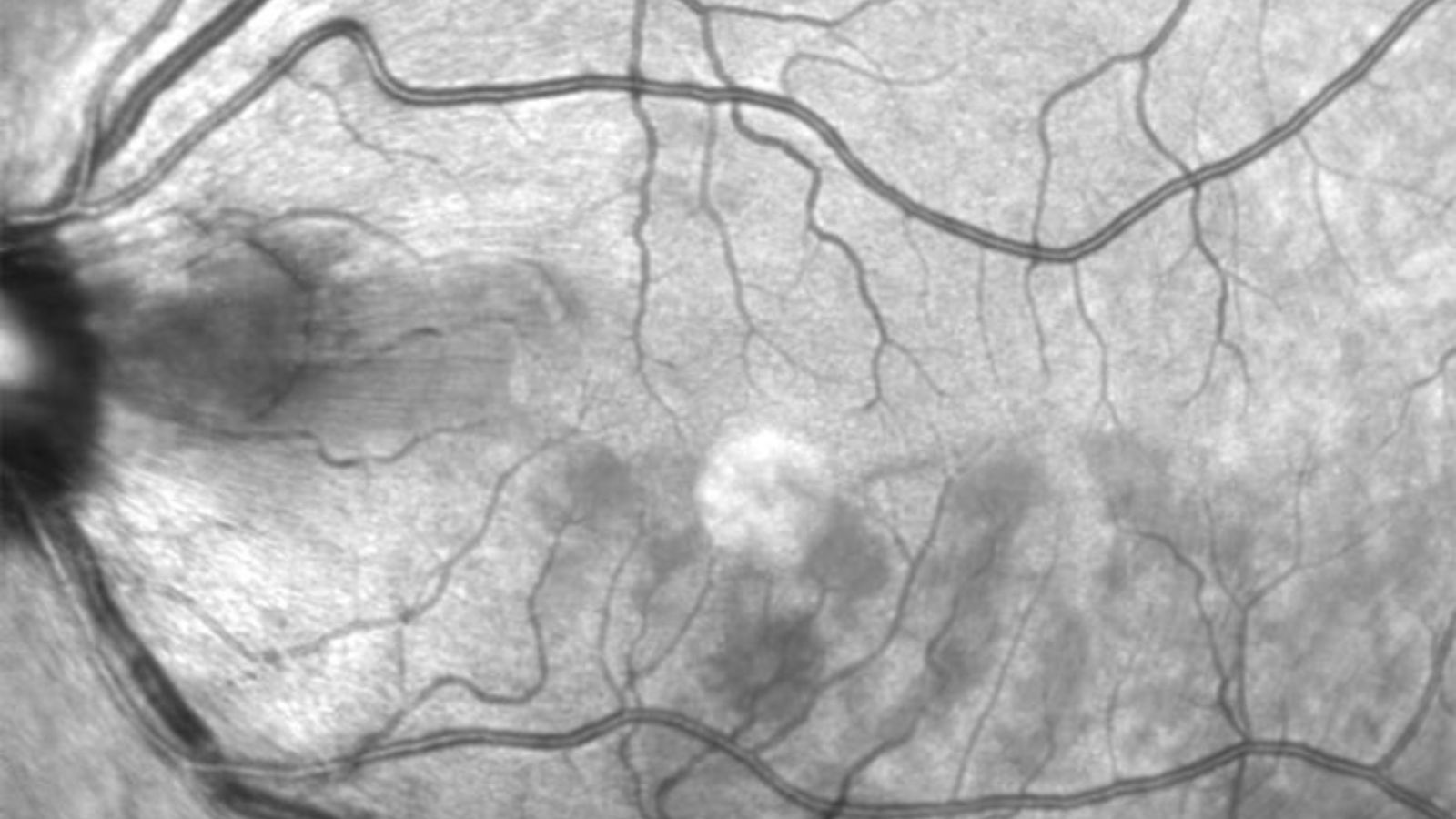 What is Cytomegalovirus Retinitis or CMV Retinitis? | Aqualens