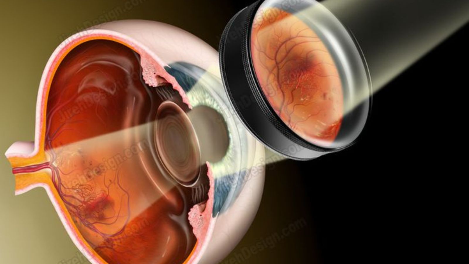 What is Branch Retinal Vein Occlusion or BRVO? | Aqualens